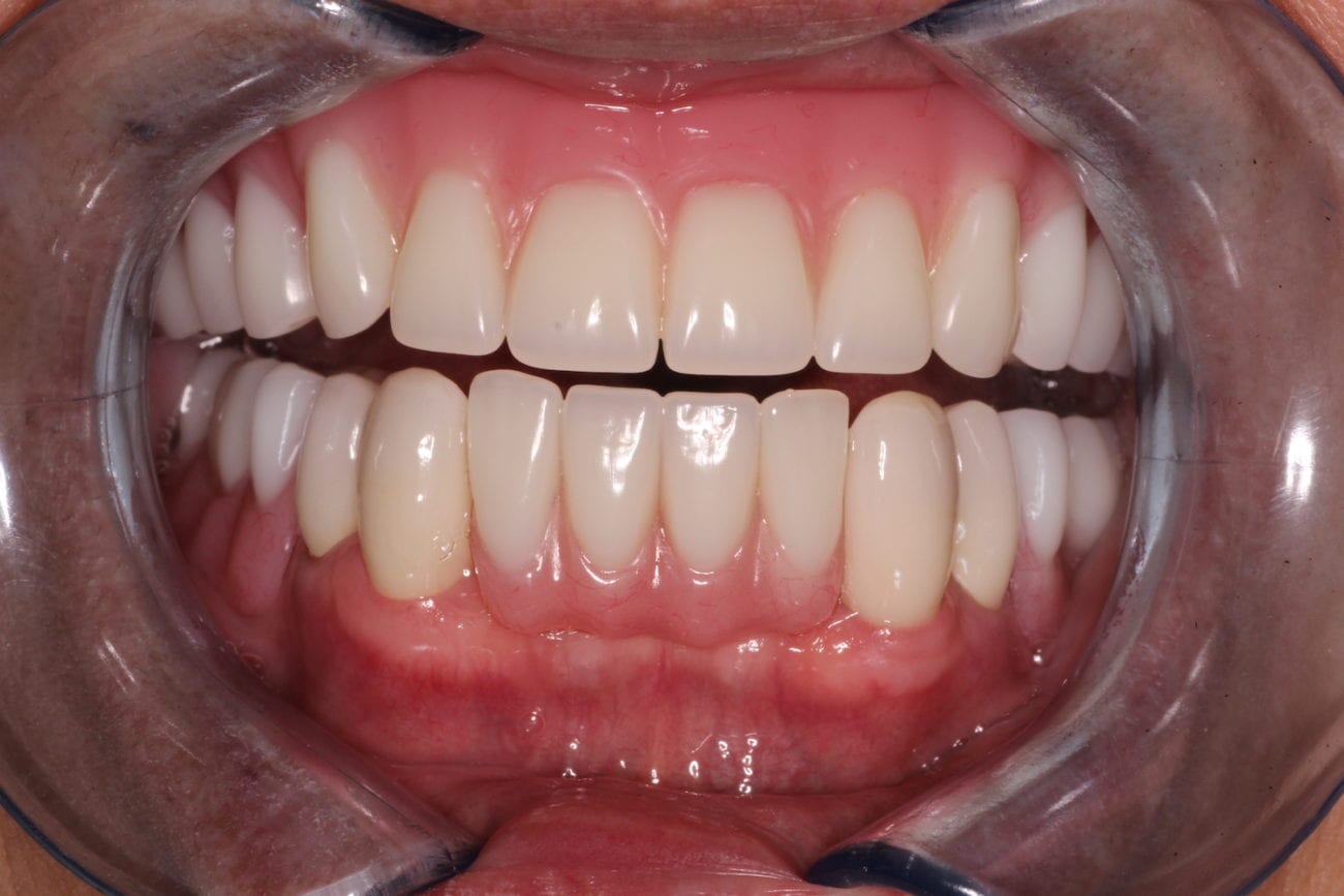 Struggling with Loose Dentures in Charlotte NC?